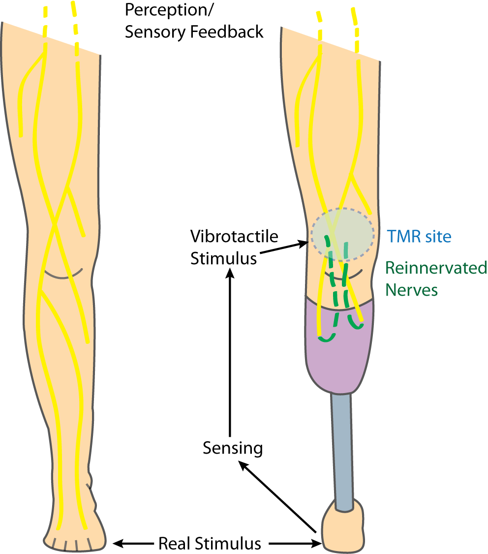 Lower-Limb TMR – UW BioRobotics Laboratory
